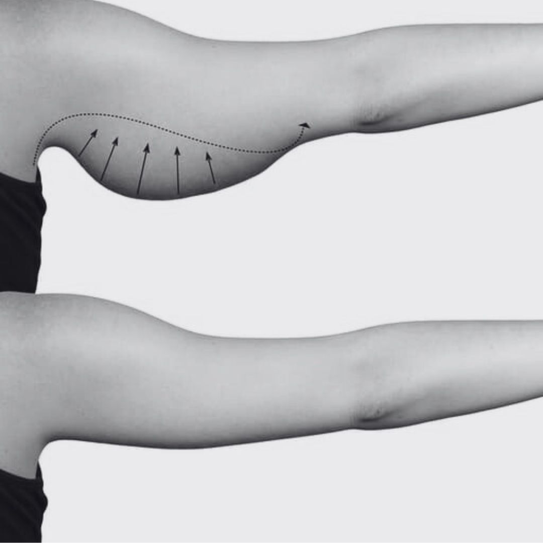 brachioplastie homme - mclinicmorocco